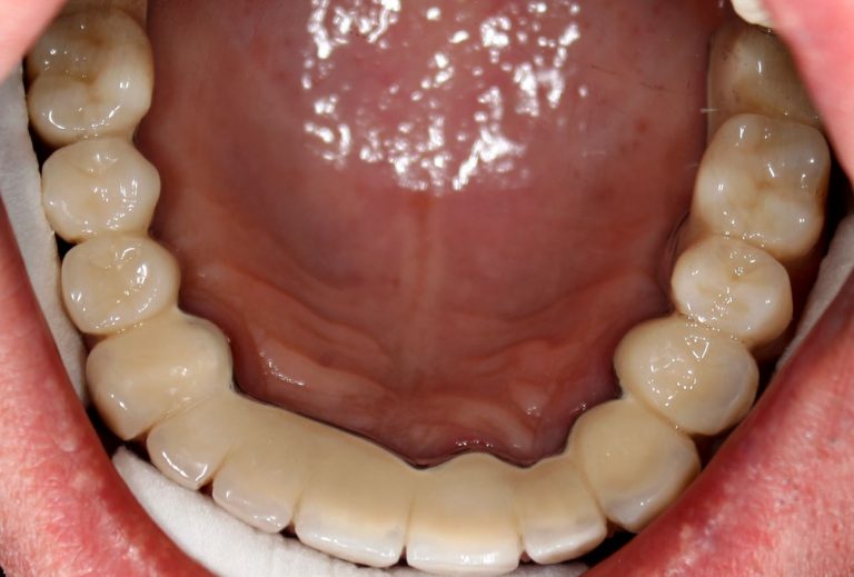 Telescopic Overdentures