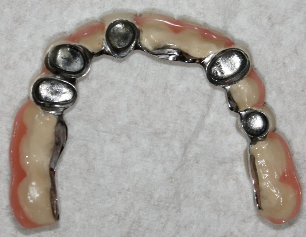 Telescopic Dentures and Bridges.