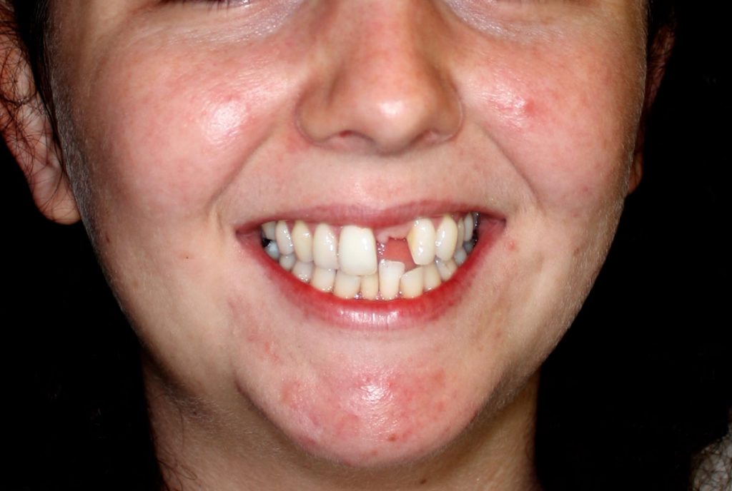 Dental Implants -single teeth - Dental World