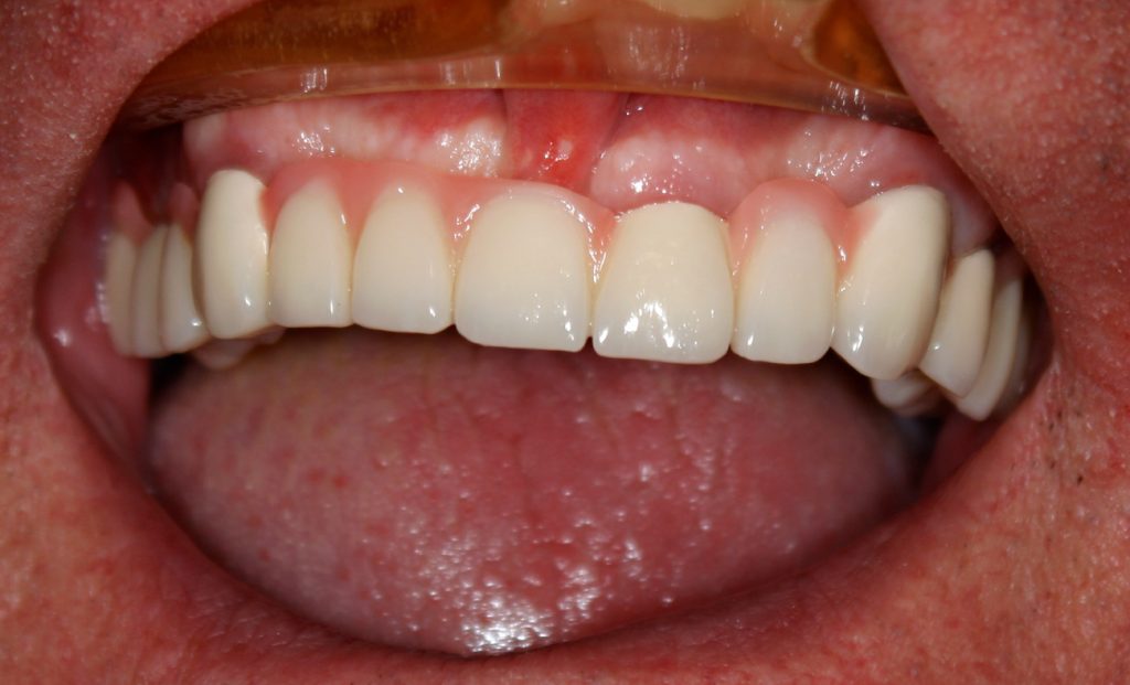 Telescopic Dentures and Bridges.