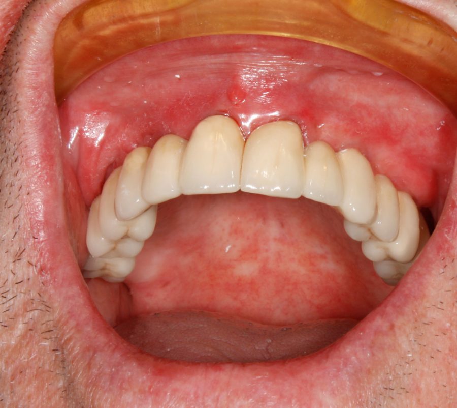 Dental Implants - multiple teeth - Dental World