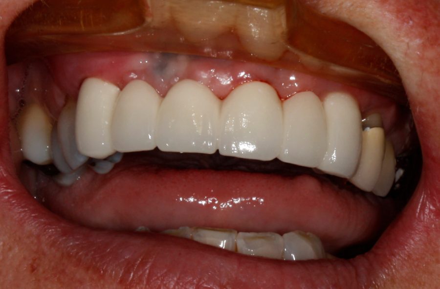 Dental Implants - multiple teeth - Dental World
