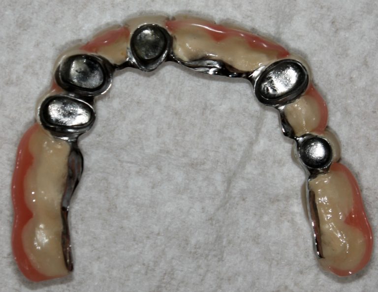 Telescopic Overdentures