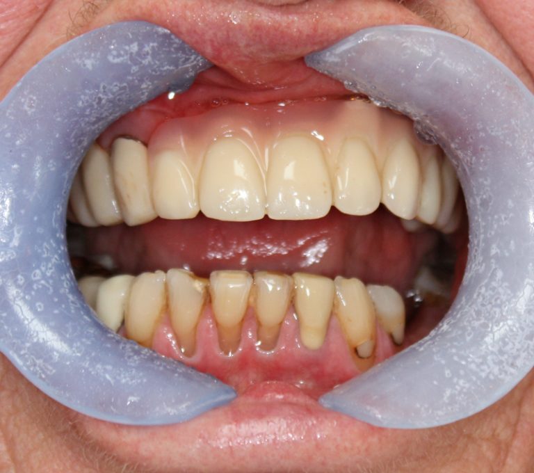 Telescopic Overdentures