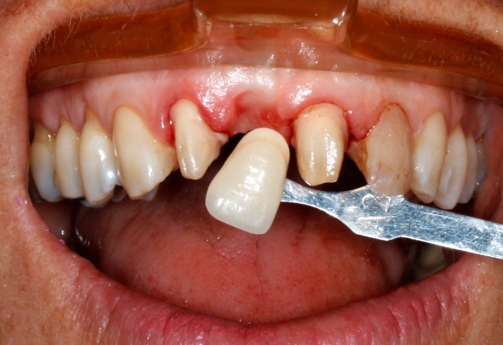 Dental Bridge Work- Case study - Dental World