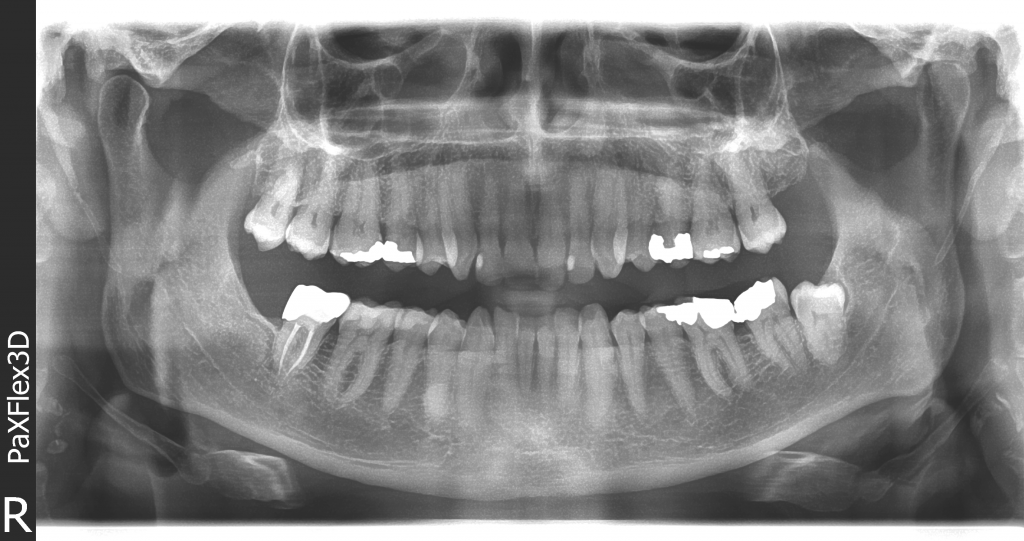 Gum/periodontal disease-Causes, risks and treatment options