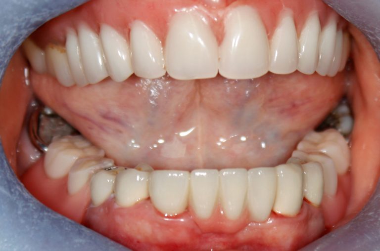 Precision Attachment Dentures - Dental World