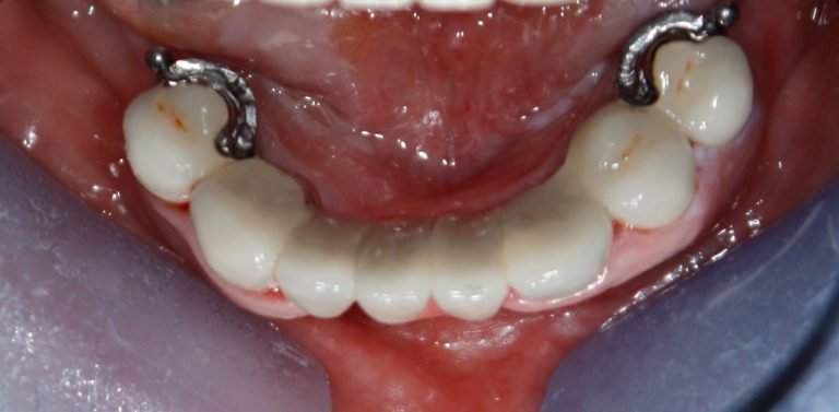 Precision Attachment Dentures - Dental World